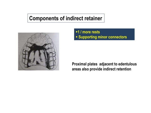 INDIRECT RETAINERS IN CAST PARTIAL DENTURES- Dr MEENU MERRY C PAUL | PPT
