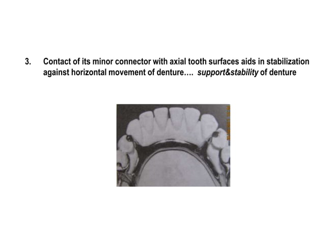 INDIRECT RETAINERS IN CAST PARTIAL DENTURES- Dr MEENU MERRY C PAUL | PPT