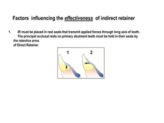 INDIRECT RETAINERS IN CAST PARTIAL DENTURES- Dr MEENU MERRY C PAUL | PPT