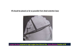 INDIRECT RETAINERS IN CAST PARTIAL DENTURES- Dr MEENU MERRY C PAUL | PPTX