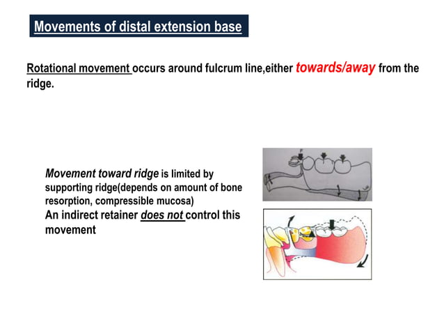 INDIRECT RETAINERS IN CAST PARTIAL DENTURES- Dr MEENU MERRY C PAUL | PPT