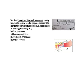 INDIRECT RETAINERS IN CAST PARTIAL DENTURES- Dr MEENU MERRY C PAUL | PPTX