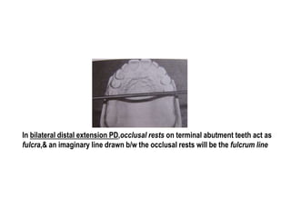 INDIRECT RETAINERS IN CAST PARTIAL DENTURES- Dr MEENU MERRY C PAUL | PPT