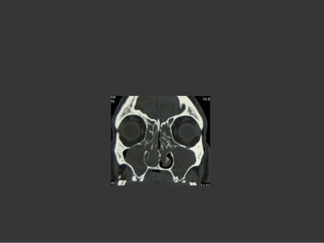 Dr Mincione percorso diagnostico, difficoltà respiratoria nasale