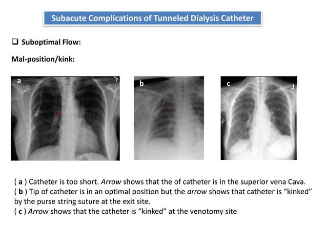 Dr mohammed abdelagawad hd catheter | PPTX | First Aid | Injuries