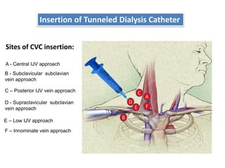 Dr mohammed abdelagawad hd catheter | PPTX