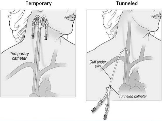 Dr mohammed abdelagawad hd catheter