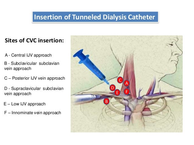 Dr mohammed abdelagawad hd catheter