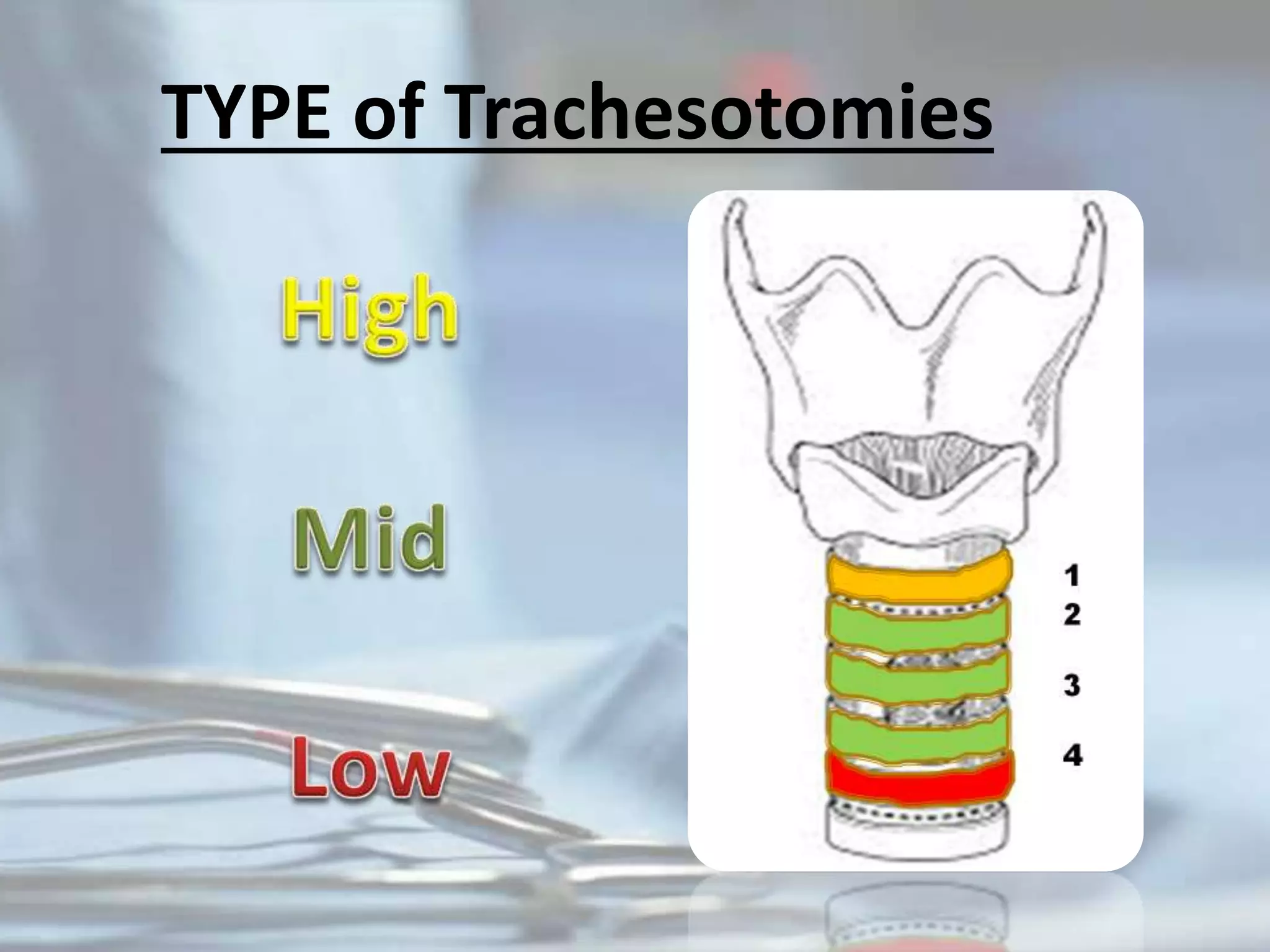 Tracheostomy - An Overview and Recent Concepts | PPTX