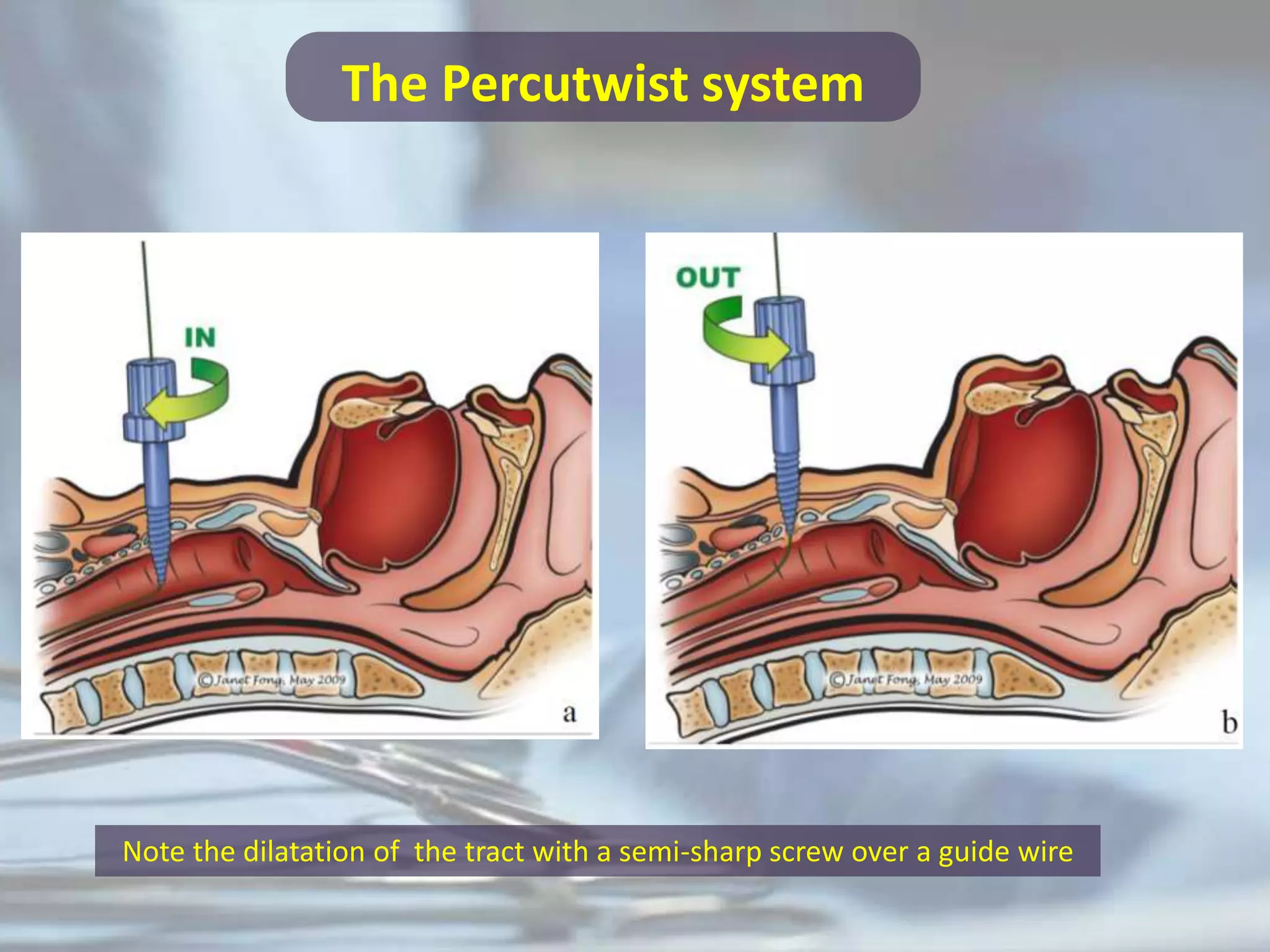 Tracheostomy - An Overview and Recent Concepts | PPTX