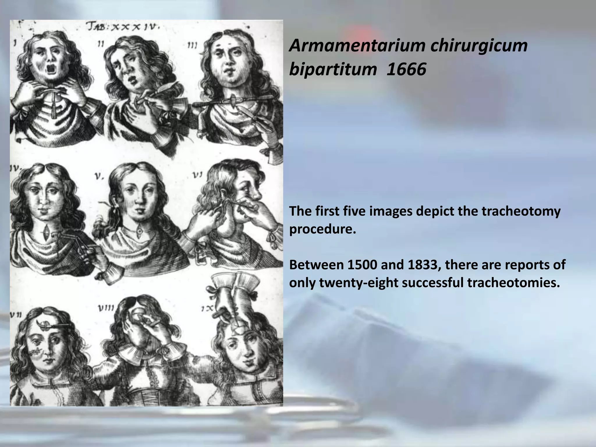 Tracheostomy - An Overview and Recent Concepts | PPTX