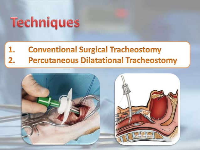 Tracheostomy - An Overview and Recent Concepts | PPTX | Ear, Nose and ...