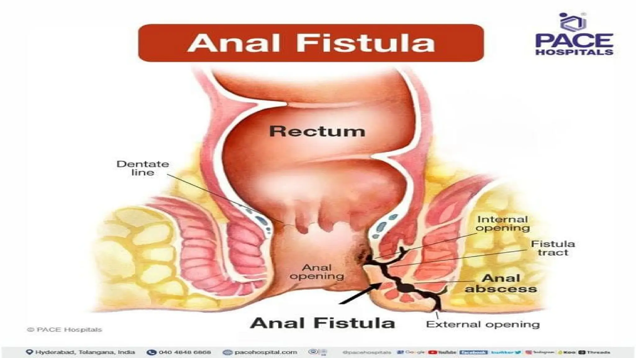 Dr Moin PGR Surgery Department IITH Topic -Fistula Sinus and cyst.pptx