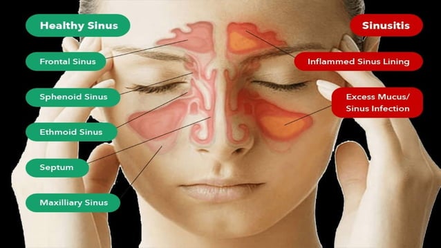 Dr Moin PGR Surgery Department IITH Topic -Fistula Sinus and cyst.pptx