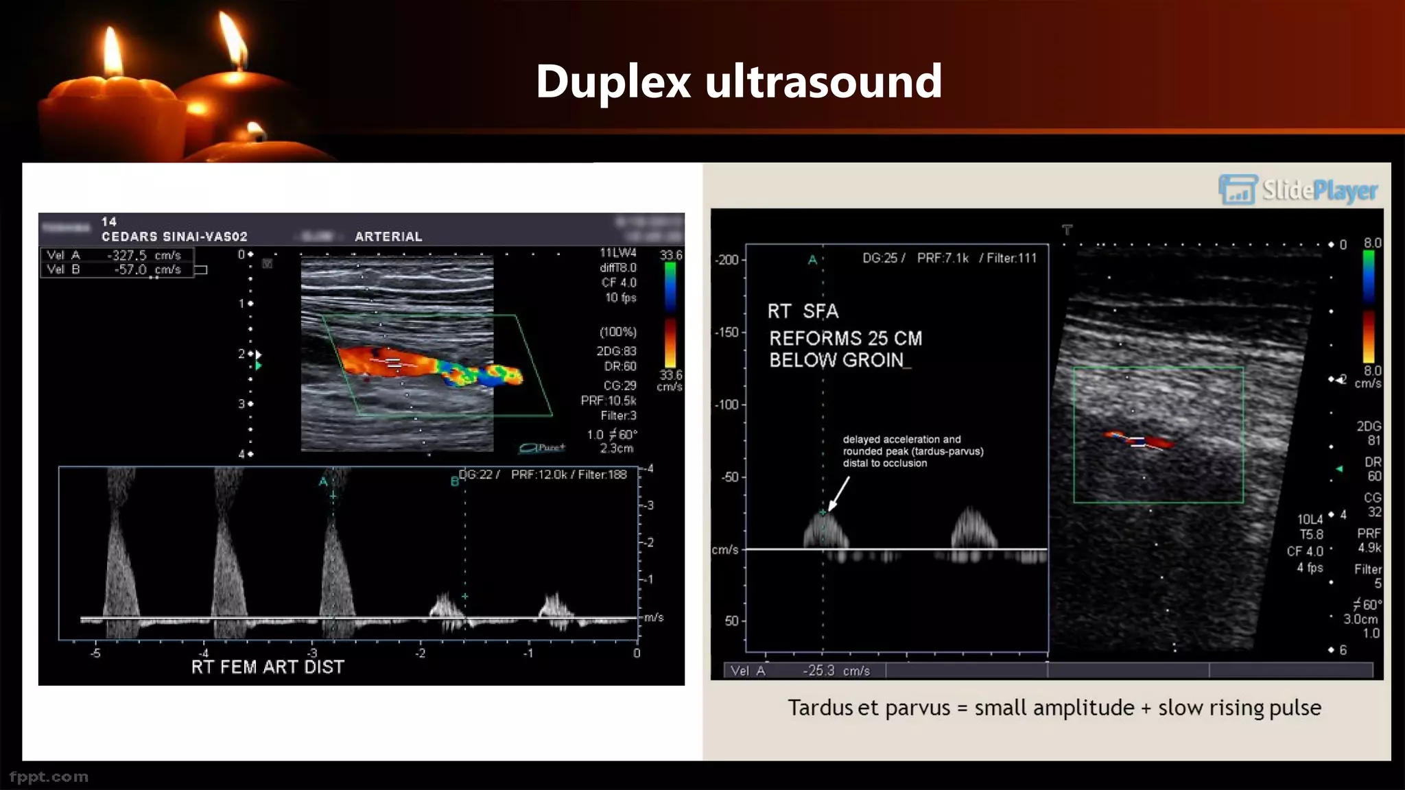dr Muhammad Diah - Penyakit Arteri Perifer.pdf