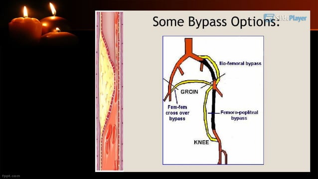 dr Muhammad Diah - Penyakit Arteri Perifer.pdf