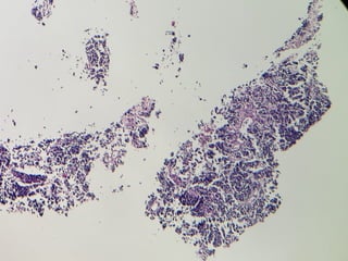 small roud cellstumors in hospitals.pptx
