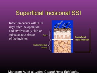 surgical site infection | PPT