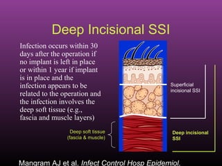 surgical site infection | PPT