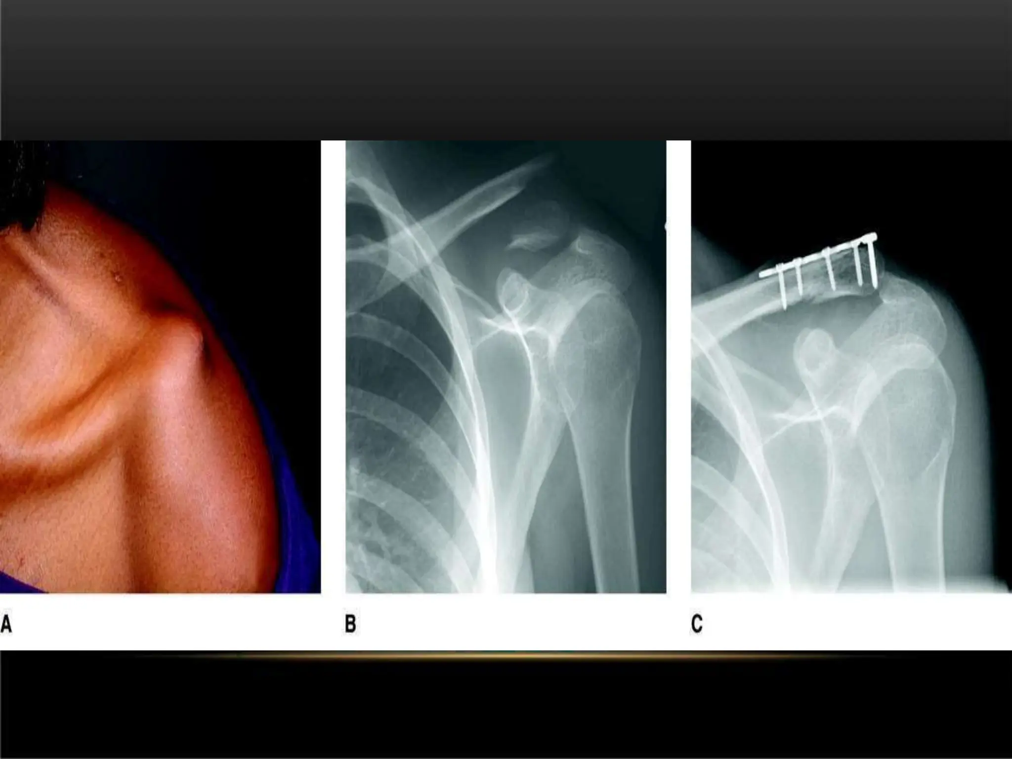 Dr Naveed clavicle fracture classification | PPTX