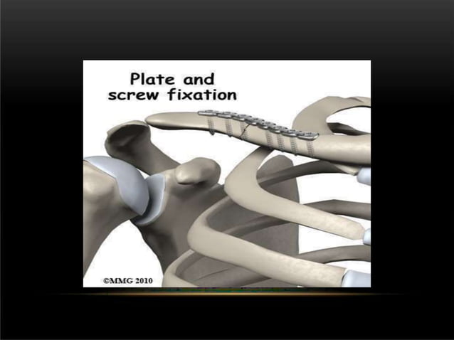 Dr Naveed clavicle fracture classification | PPTX