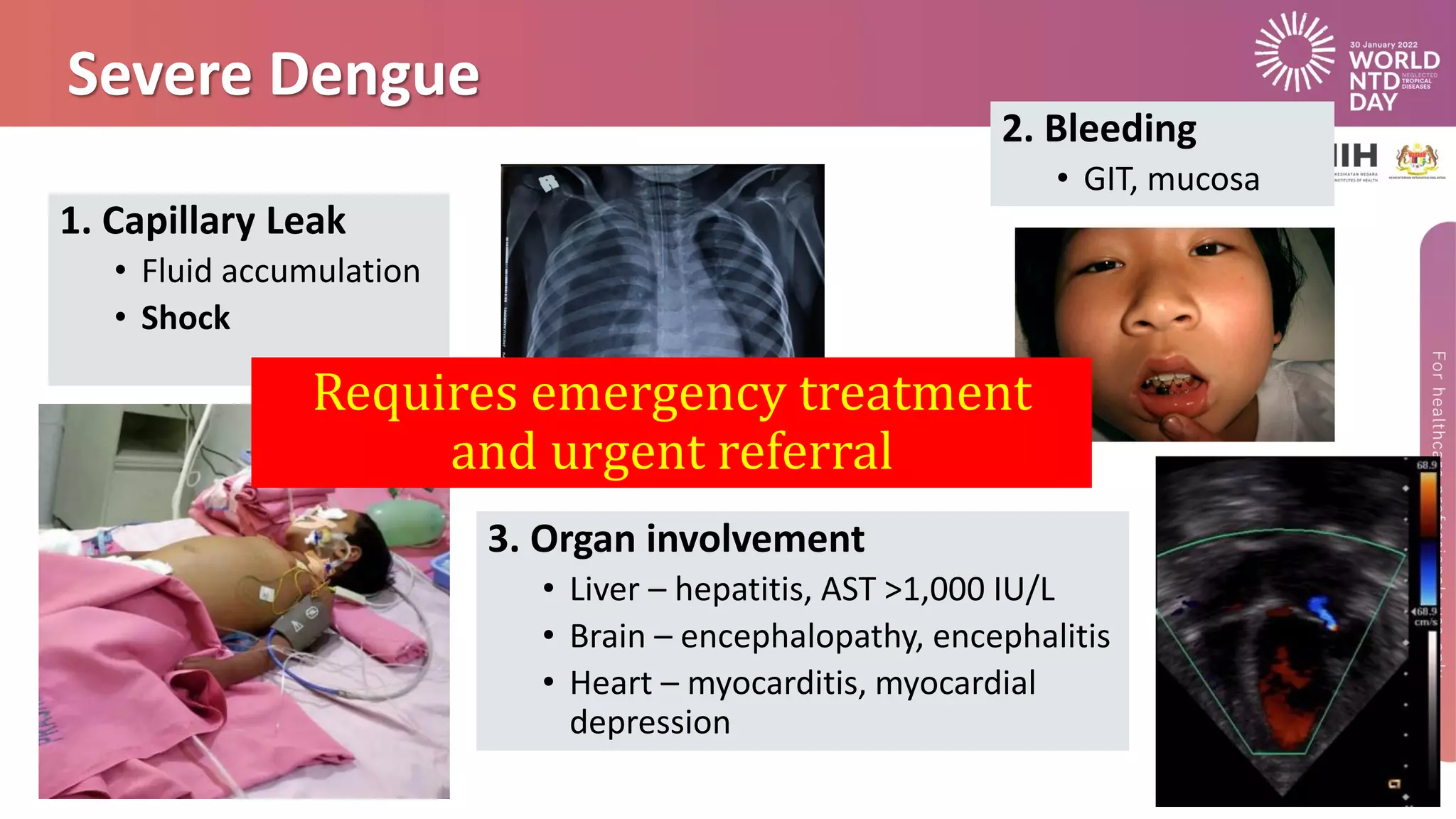 06NTD 2022 - Managing Dengue in Children: an update | PDF