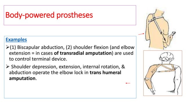 Upper Limb Prosthetics - Dr Om Prakash | PPTX | Physical Therapy | Wellness