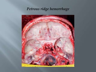 Drowning Chapter from Forensic Medicine.pptx