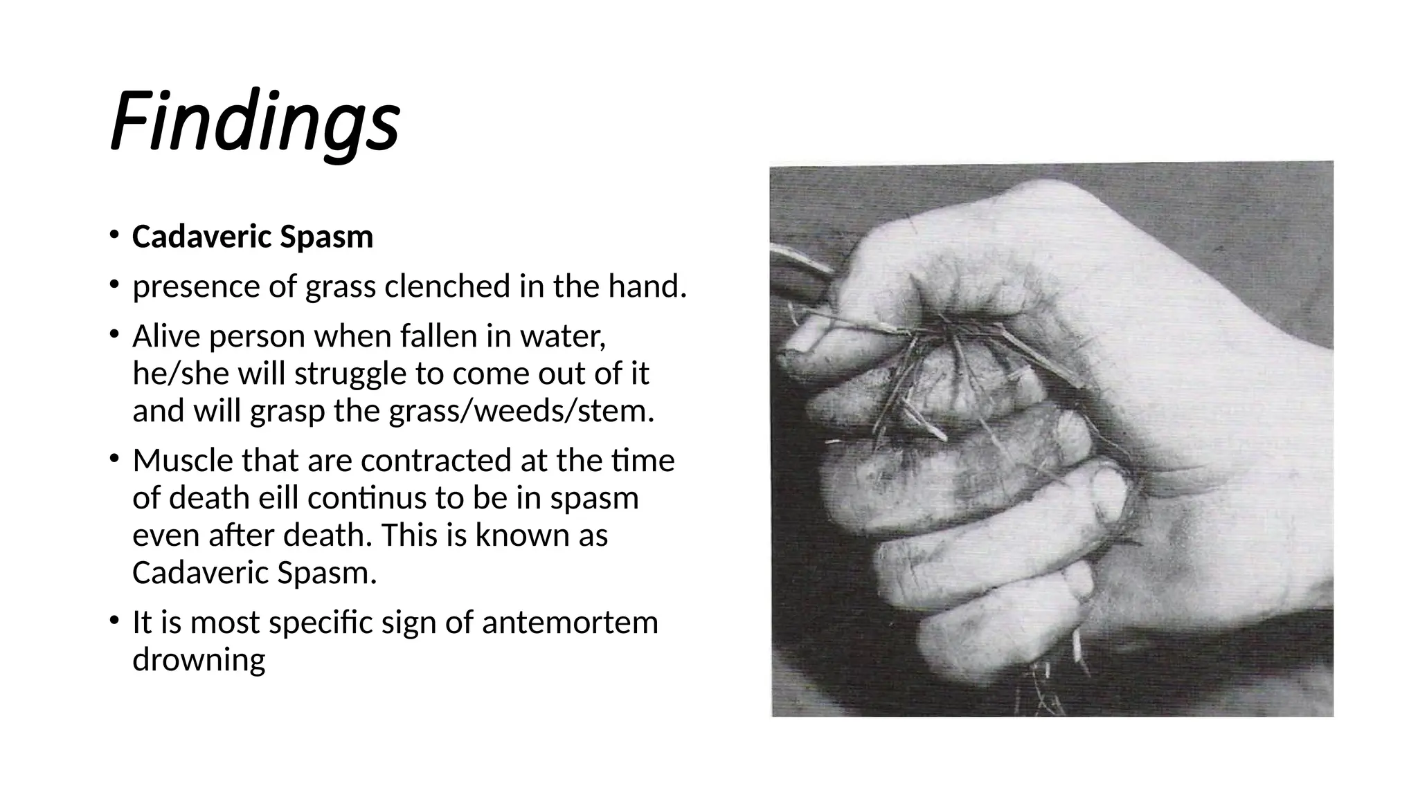 Drowning A detailed Case Study from postmortem examination | PPTX