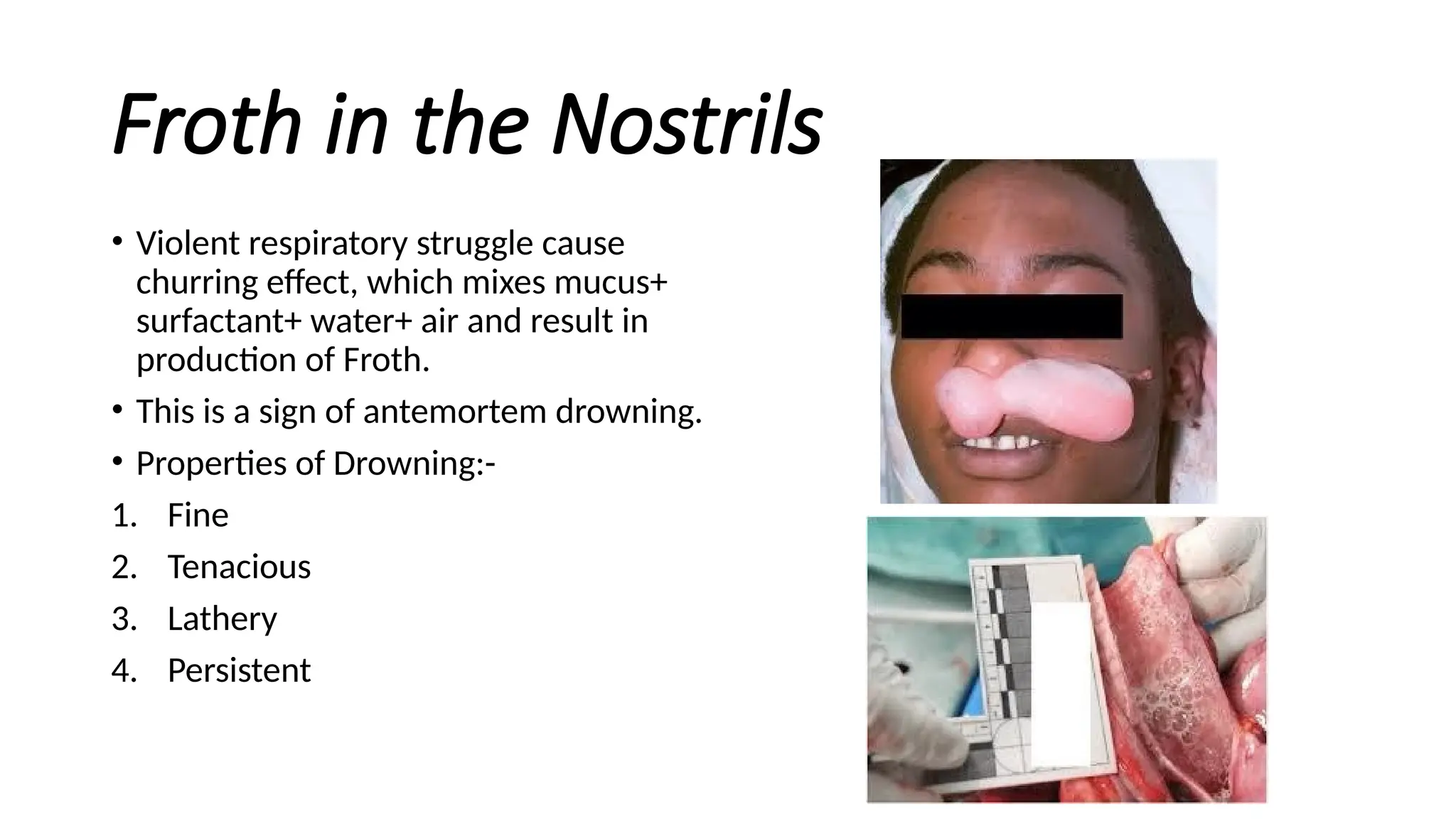 Drowning A detailed Case Study from postmortem examination | PPTX