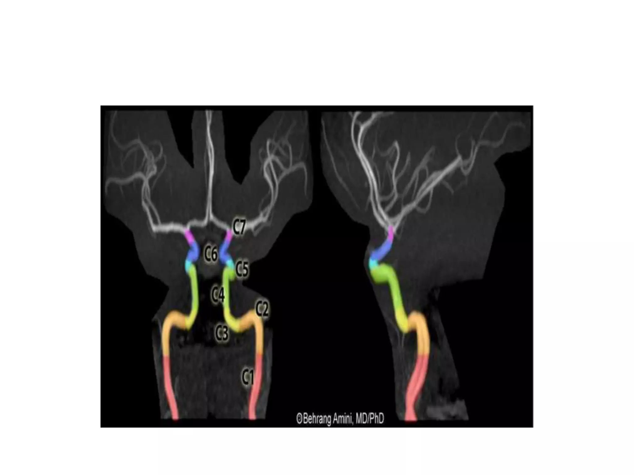 Carotid Artery Stenosis Dr Pankaj Rathi DM Traine Shri Aurobindo ...