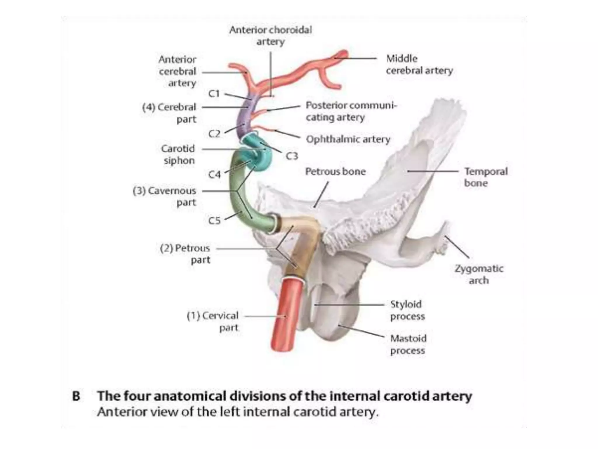 Carotid Artery Stenosis Dr Pankaj Rathi DM Traine Shri Aurobindo ...
