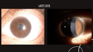 Dr Parnika - management of post transepithelial photorefractive ...