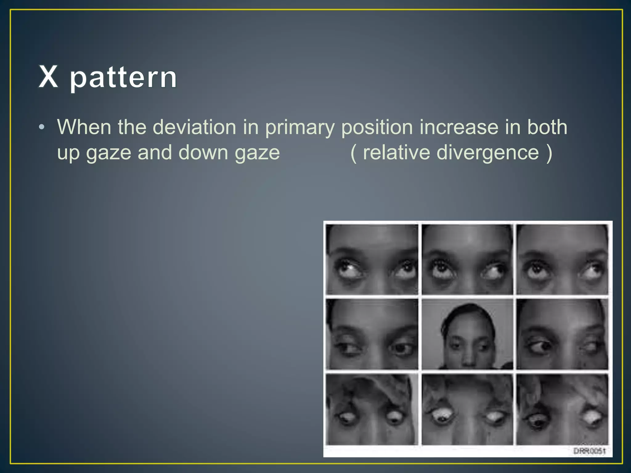 Pattern Strabismus | A.V Pattern | PPTX