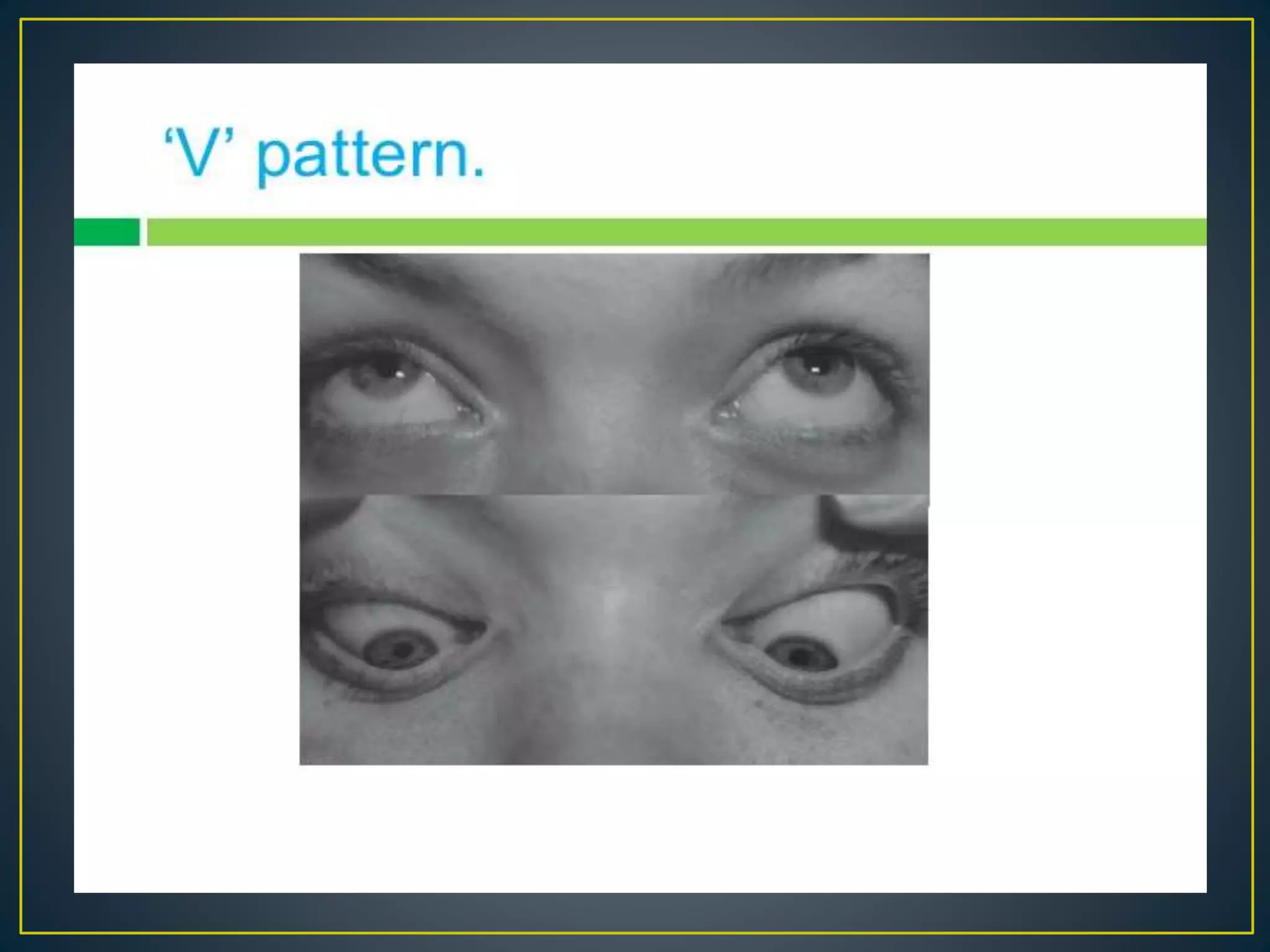 Pattern Strabismus | A.V Pattern | PPTX