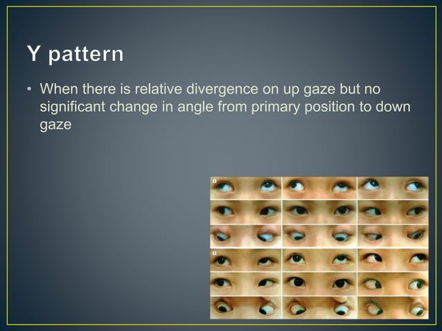 Pattern Strabismus | A.V Pattern | PPTX | Eye and Vision Conditions ...