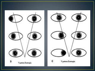 Pattern Strabismus | A.V Pattern | PPTX