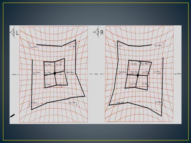 Pattern Strabismus | A.V Pattern | PPTX | Eye and Vision Conditions ...