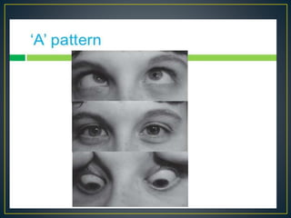 Pattern Strabismus | A.V Pattern | PPTX