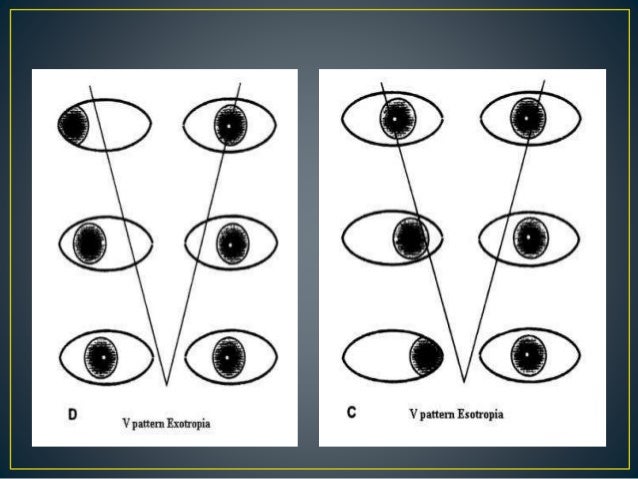 Pattern Strabismus | A.V Pattern