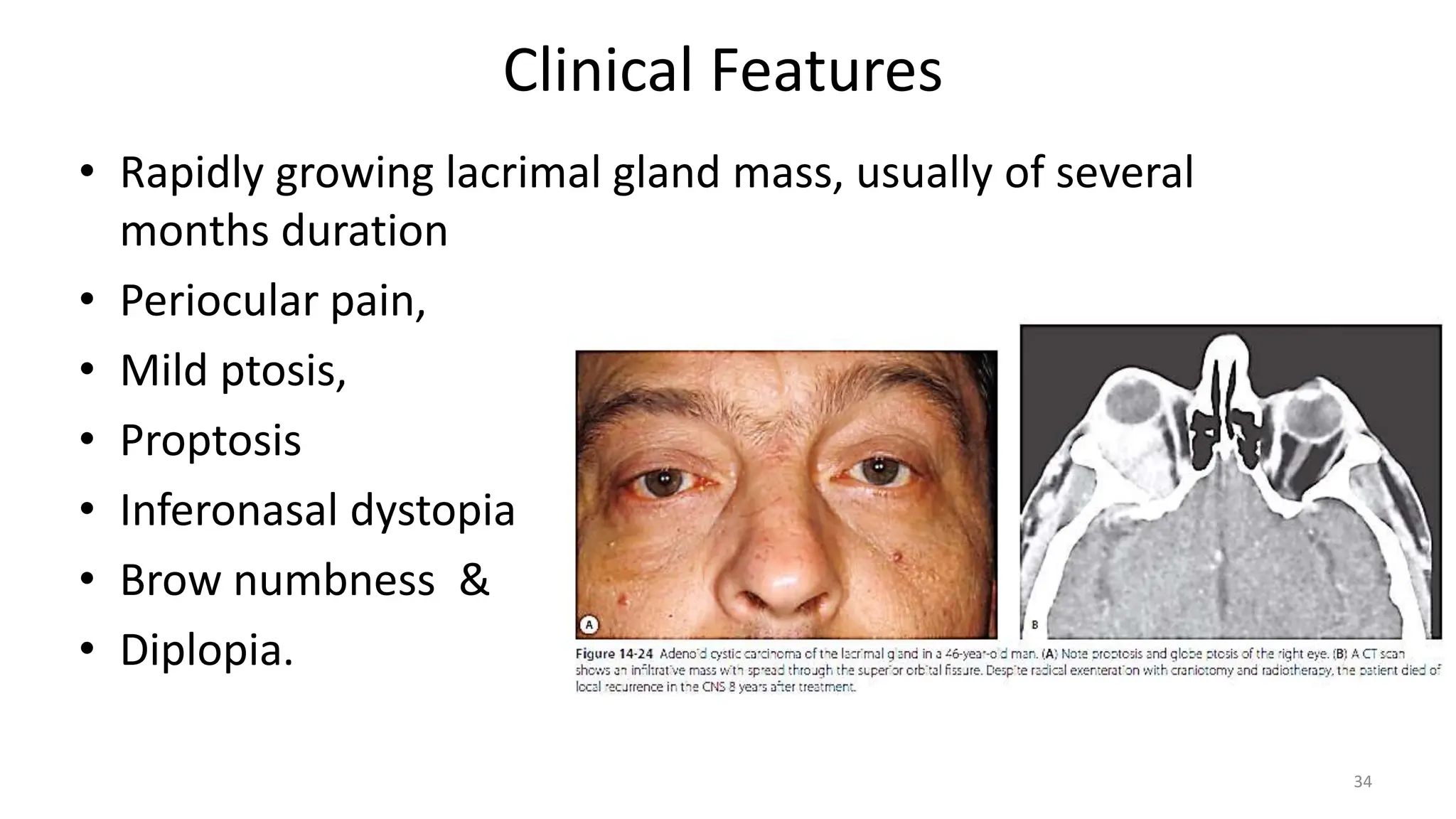 Lacrimal Gland Tumor-Dr.PrabhatDevkota.pptx