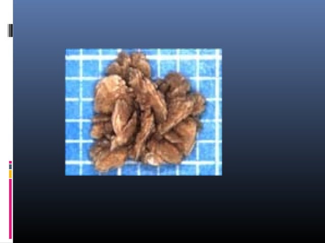 Ashmari NIDANA SAMPRAPTI | PPT | Digestive Disorders | Diseases and ...