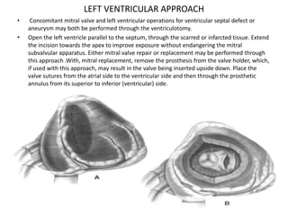 Mitral valve surgical anatomy DR NIKUNJ R SHEKHADA (MBBS ,MS GRN SURG ...