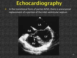 Endocardial Cushion Defect Echo