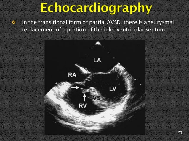 Partial Endocardial Cushion Defect
