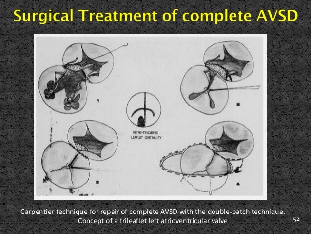 Dr ranjith mp av canal defect