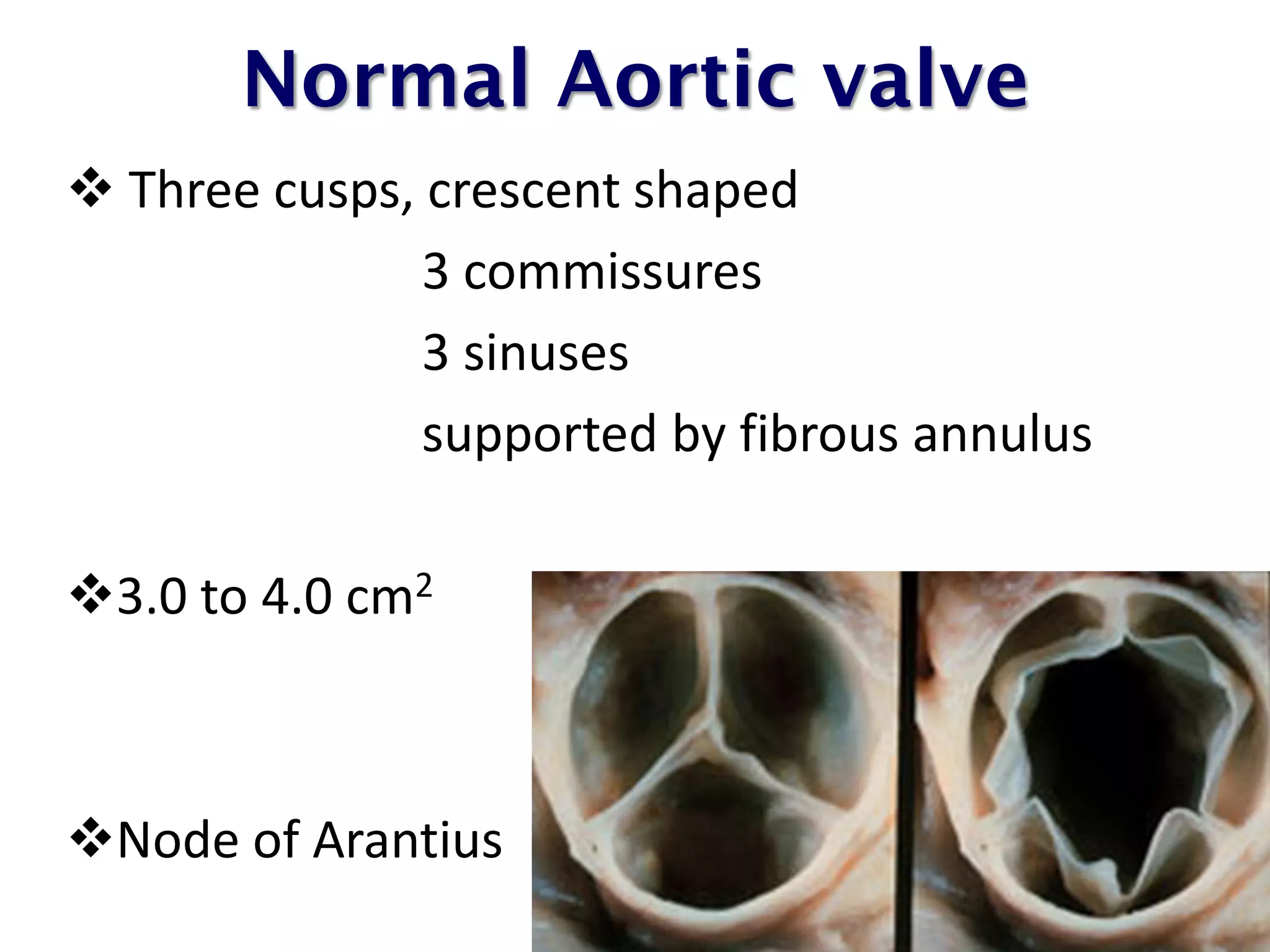 Echo assessment of Aortic Stenosis | PDF