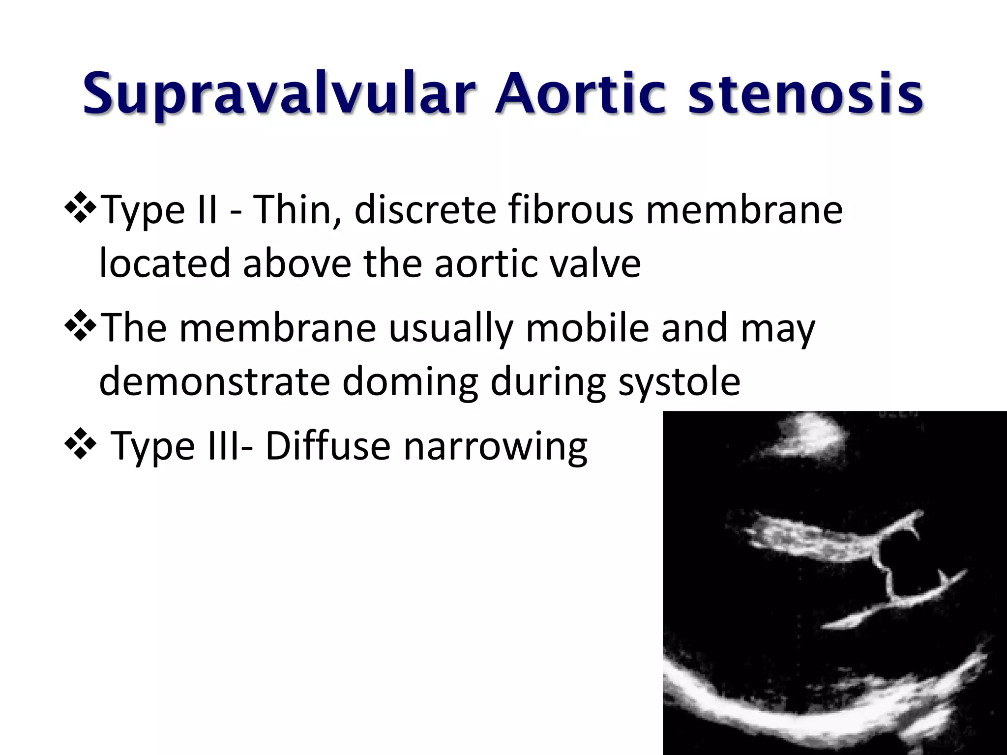 Echo assessment of Aortic Stenosis | PDF