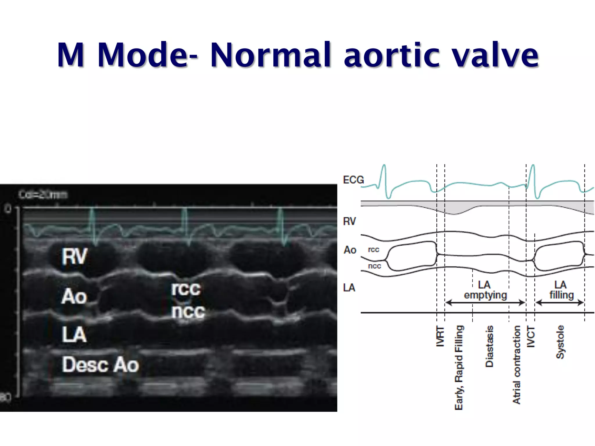 Echo assessment of Aortic Stenosis | PDF