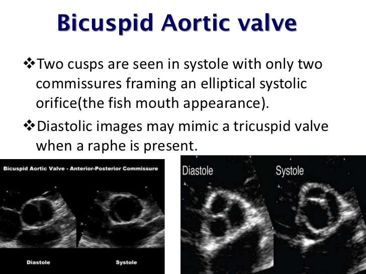 Echo assessment of Aortic Stenosis
